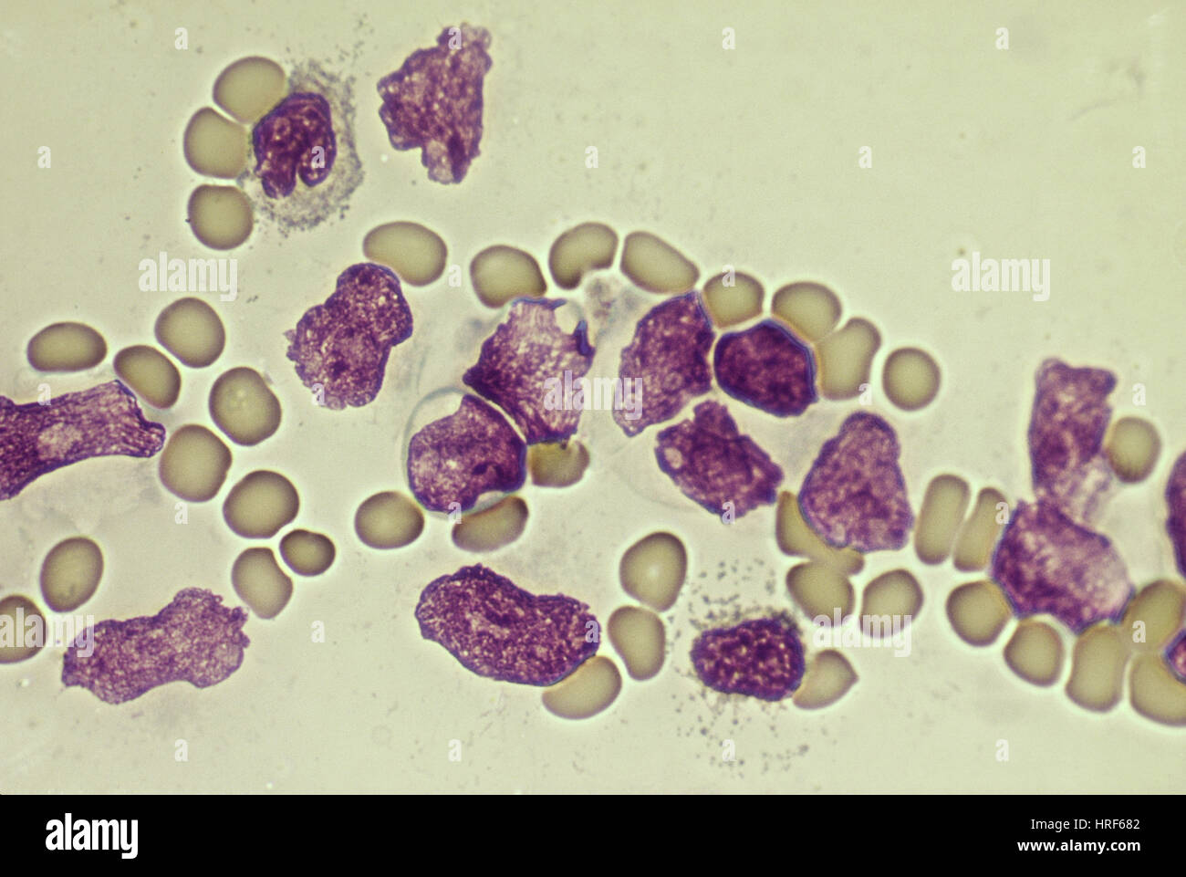 Acute leukemia hi-res stock photography and images - Alamy