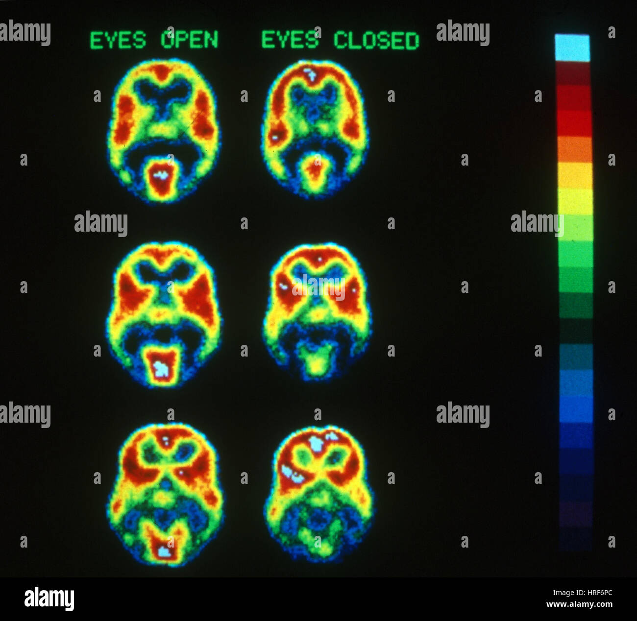 PET Brain Scan, Eyes Open and Shut Stock Photo - Alamy