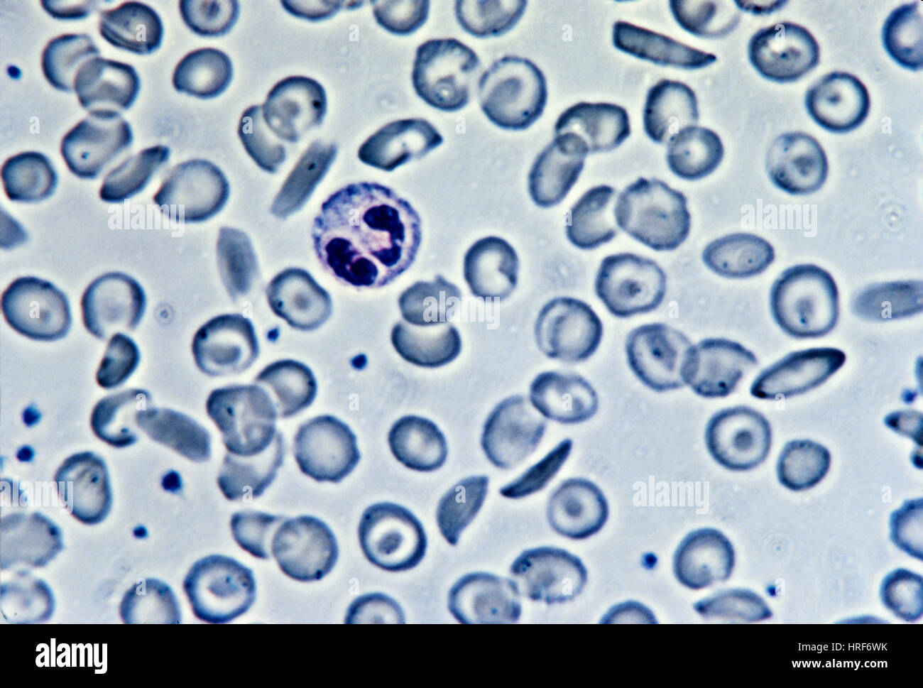 Diseases such as sickle cell anemia hi-res stock photography and images ...