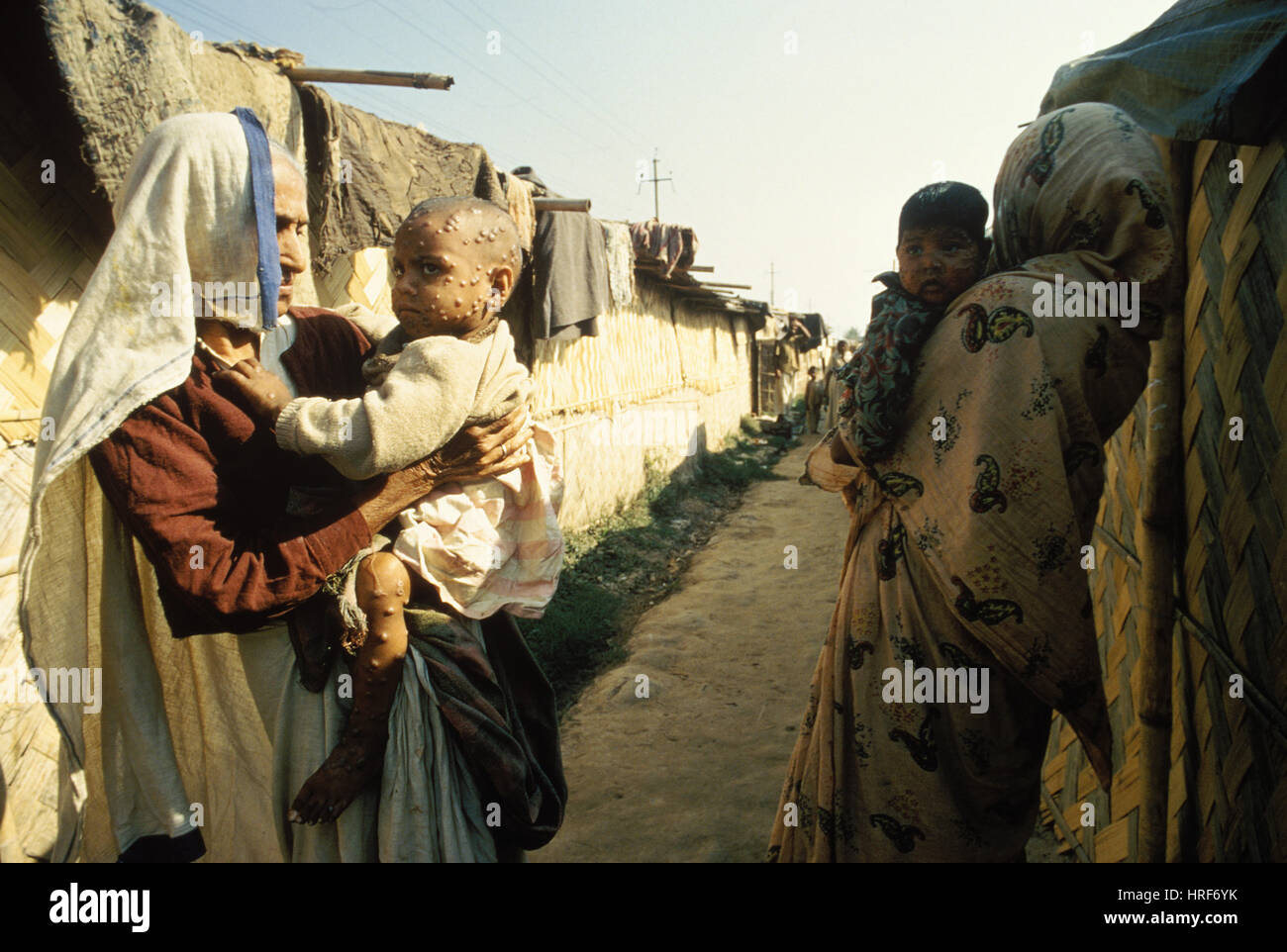 Smallpox small pox disease hi-res stock photography and images - Alamy