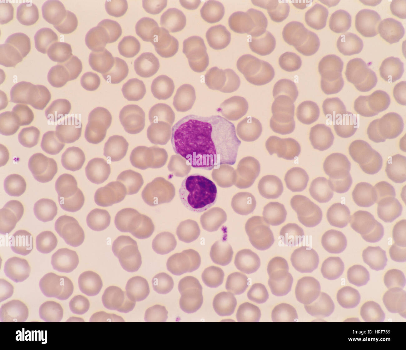 Mononucleosis lymphocyte hi-res stock photography and images - Alamy