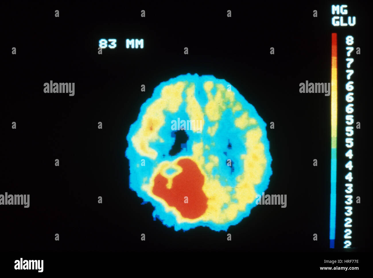 PET Brain Scan, Malignant Tumor Stock Photo - Alamy