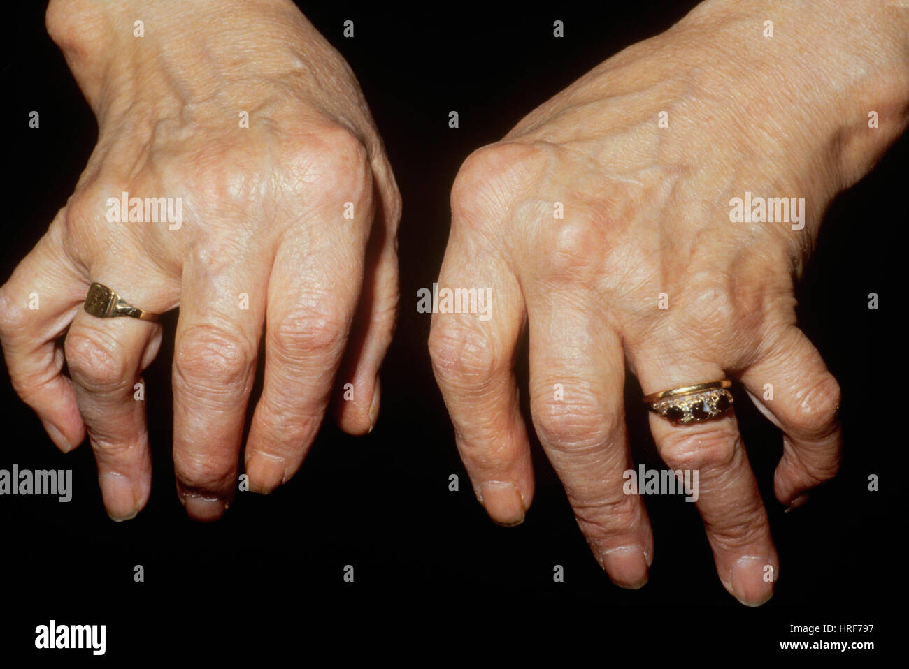 Arthritis synovitis hi-res stock photography and images - Alamy
