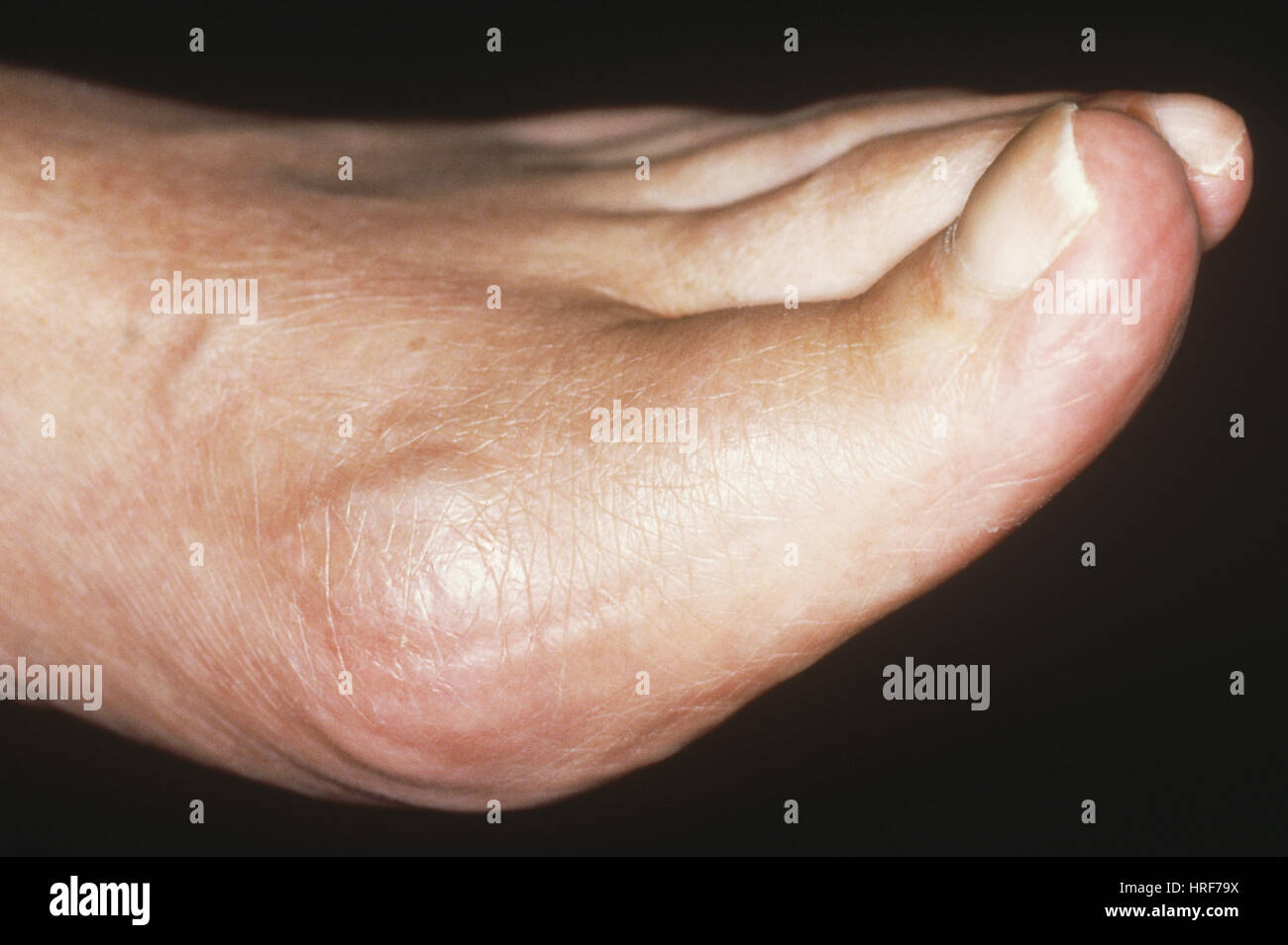 Skin deformity hi-res stock photography and images - Alamy