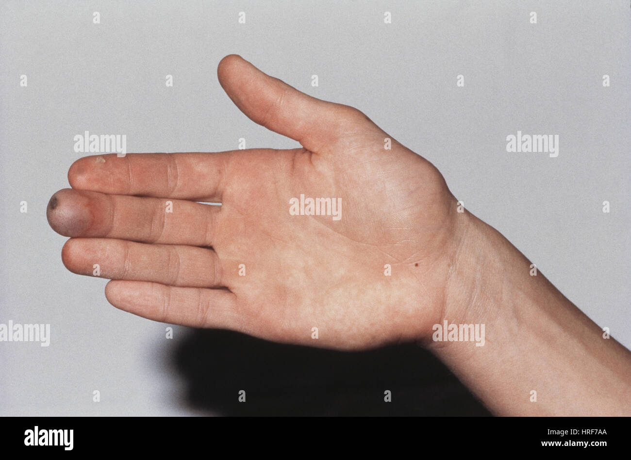 Frostbite hand hi-res stock photography and images - Alamy