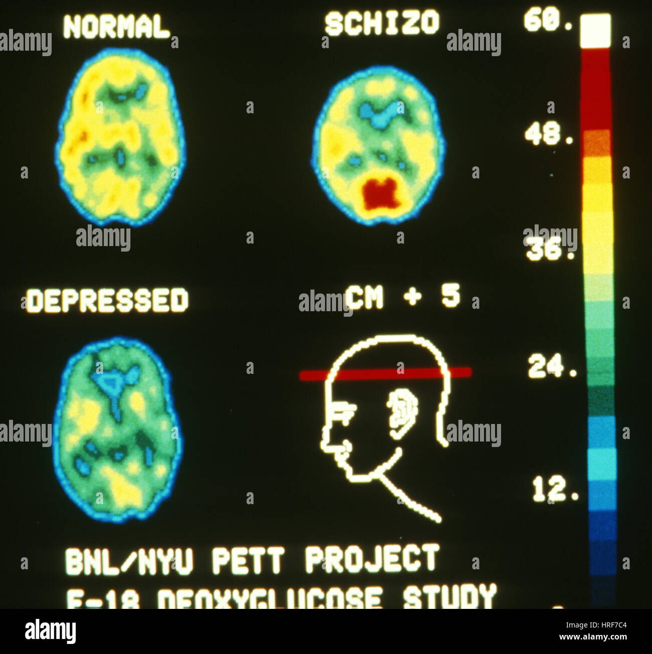 Brain Scan Depression