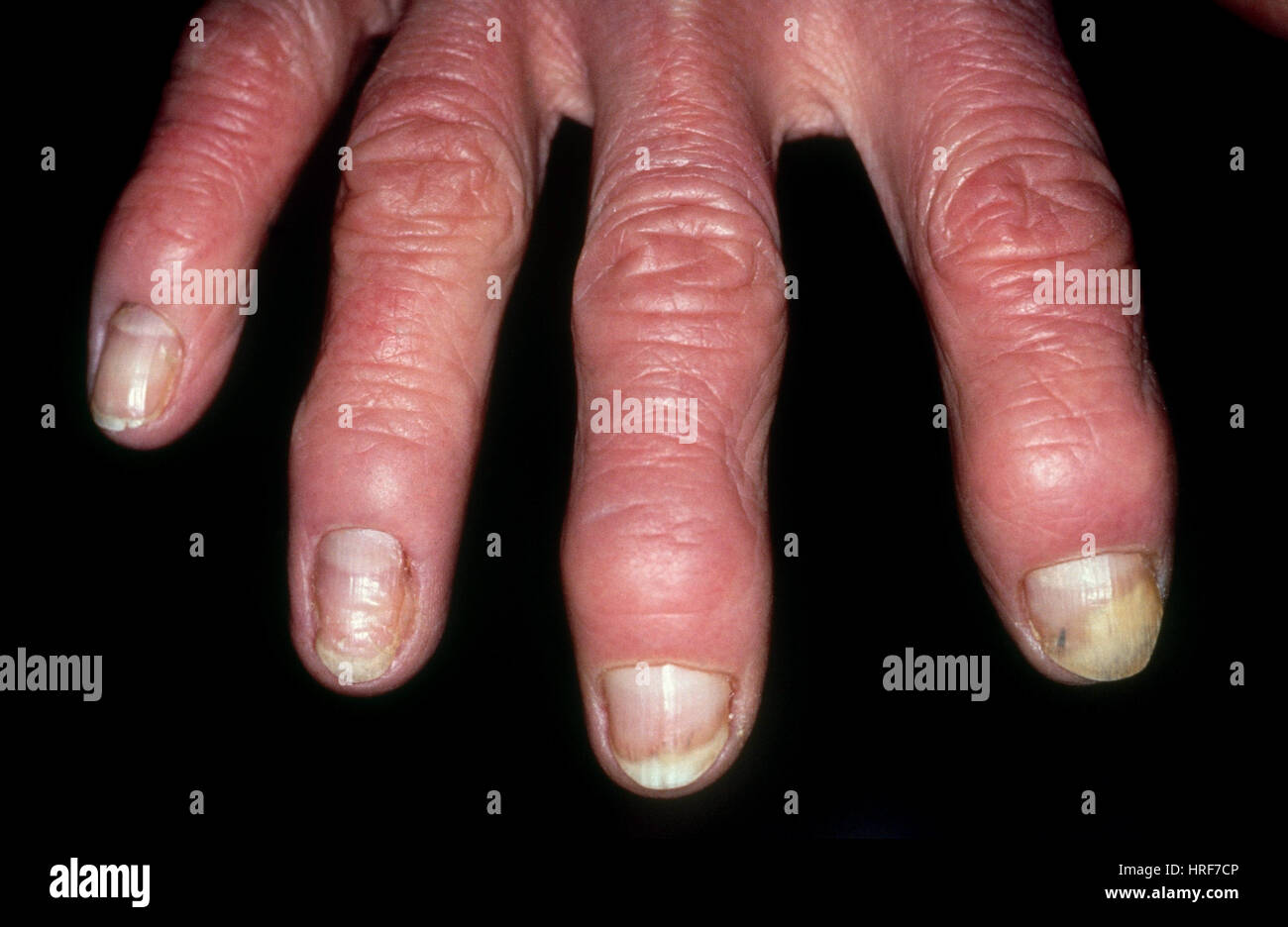 Psoriatic Arthritis Hand Hi Res Stock Photography And Images Alamy
