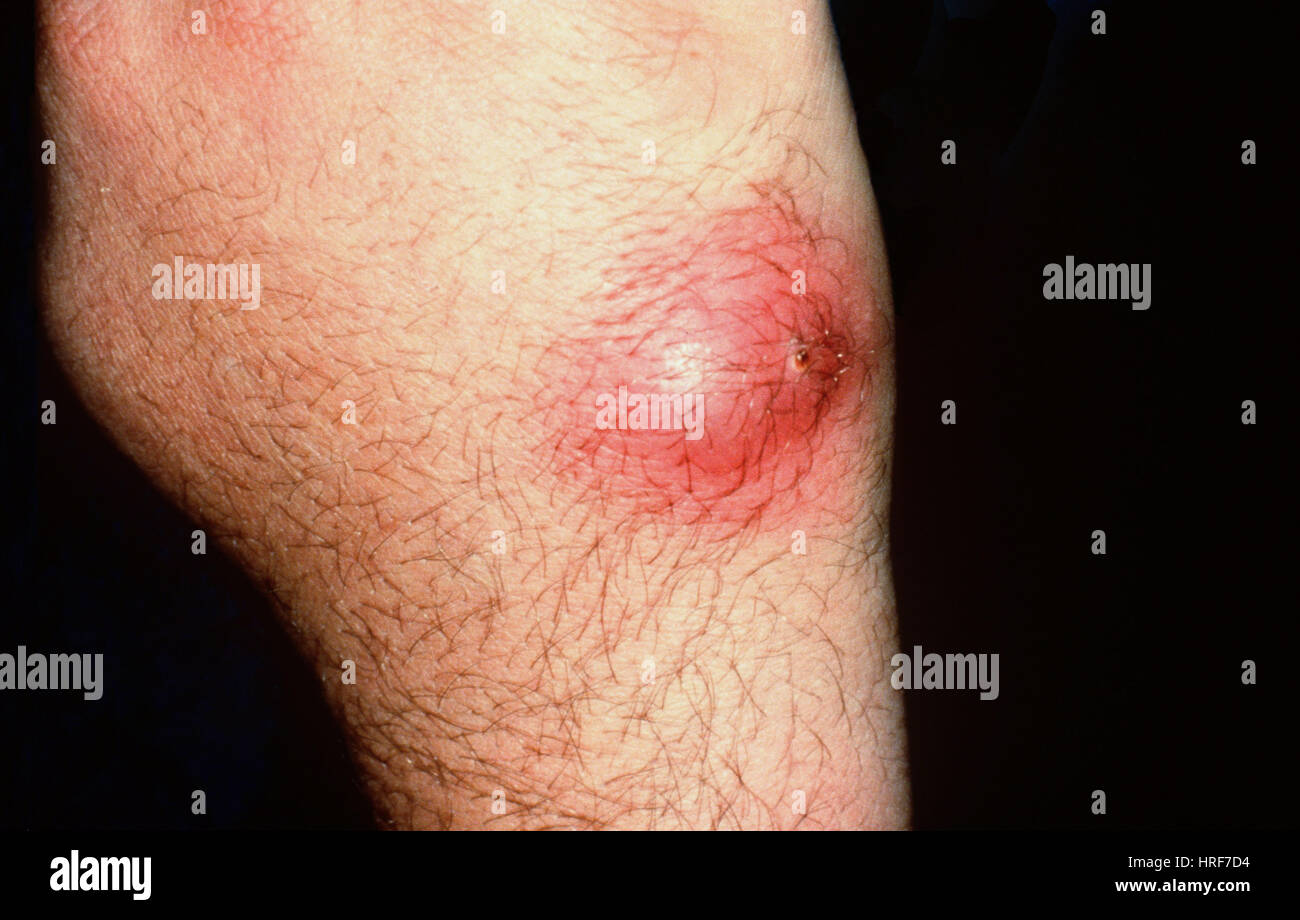 Abscess Hand Stock Photos & Abscess Hand Stock Images - Alamy