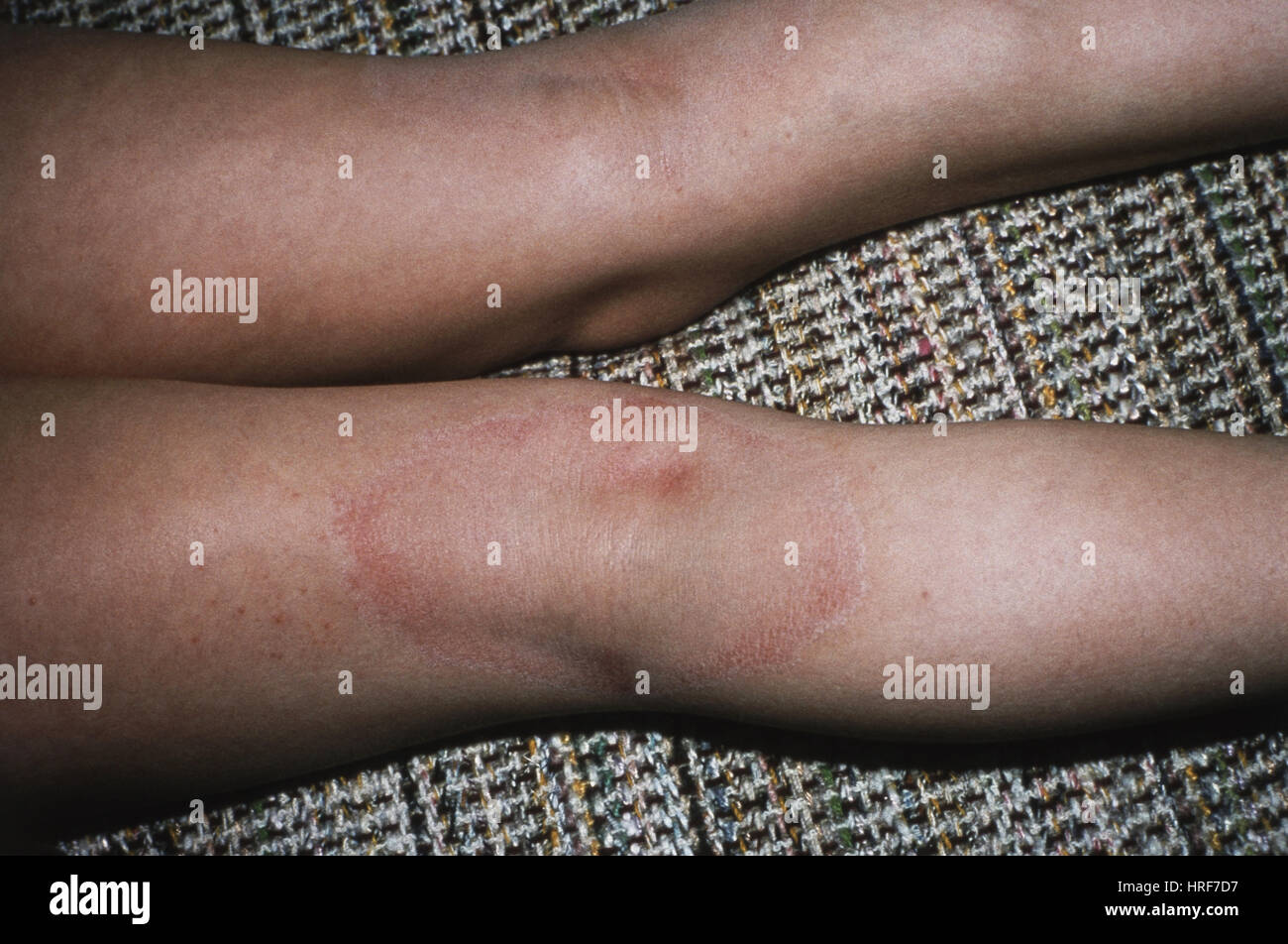 Corynebacterium Minutissimum