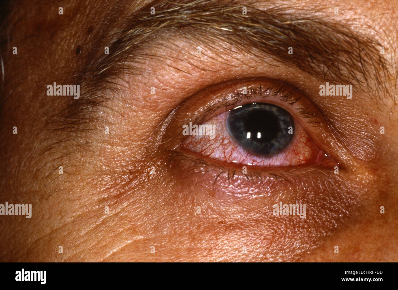 Pink eyes conjunctivitis hi-res stock photography and images - Alamy