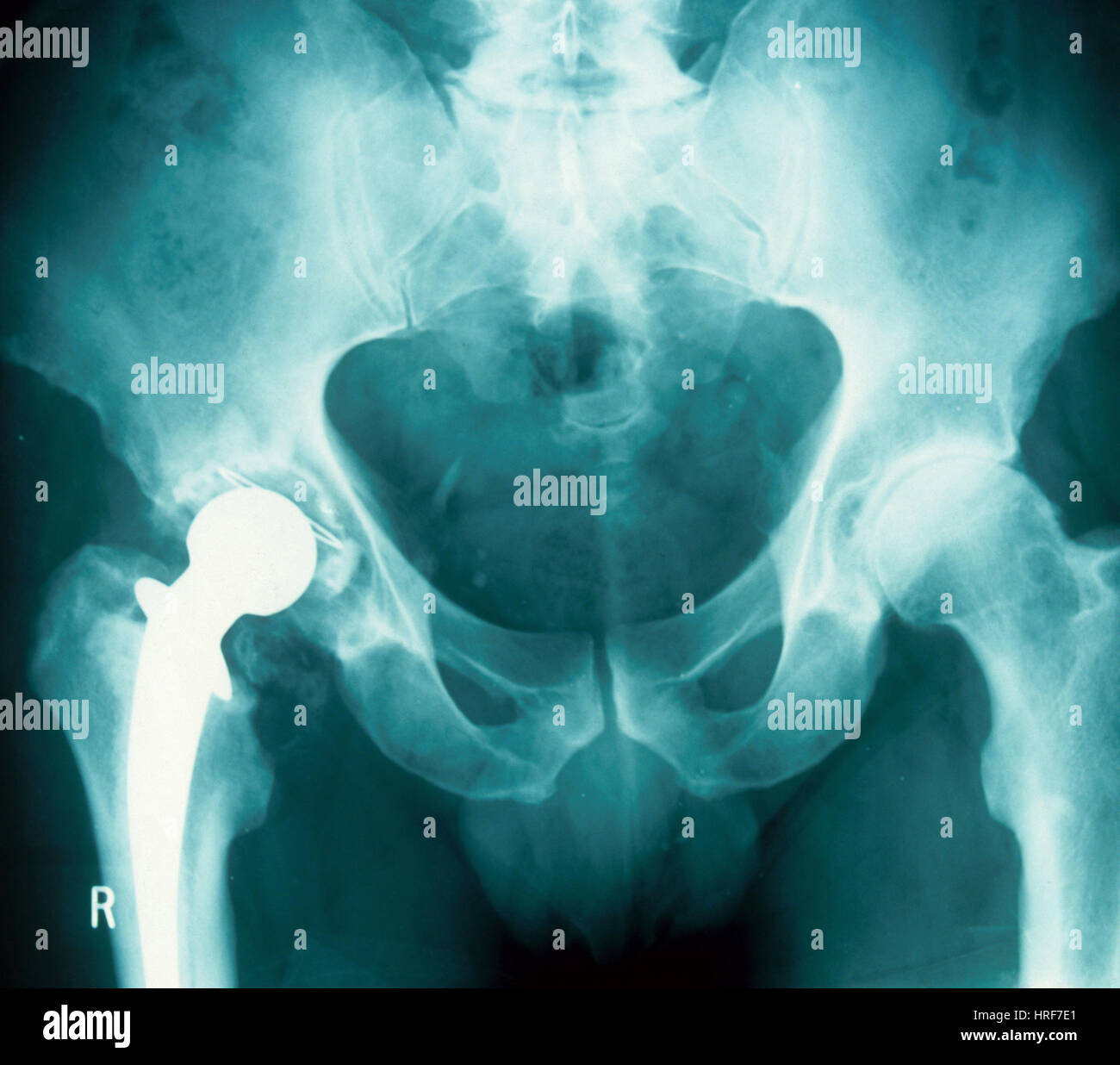 Hip replacement xray hi-res stock photography and images - Alamy