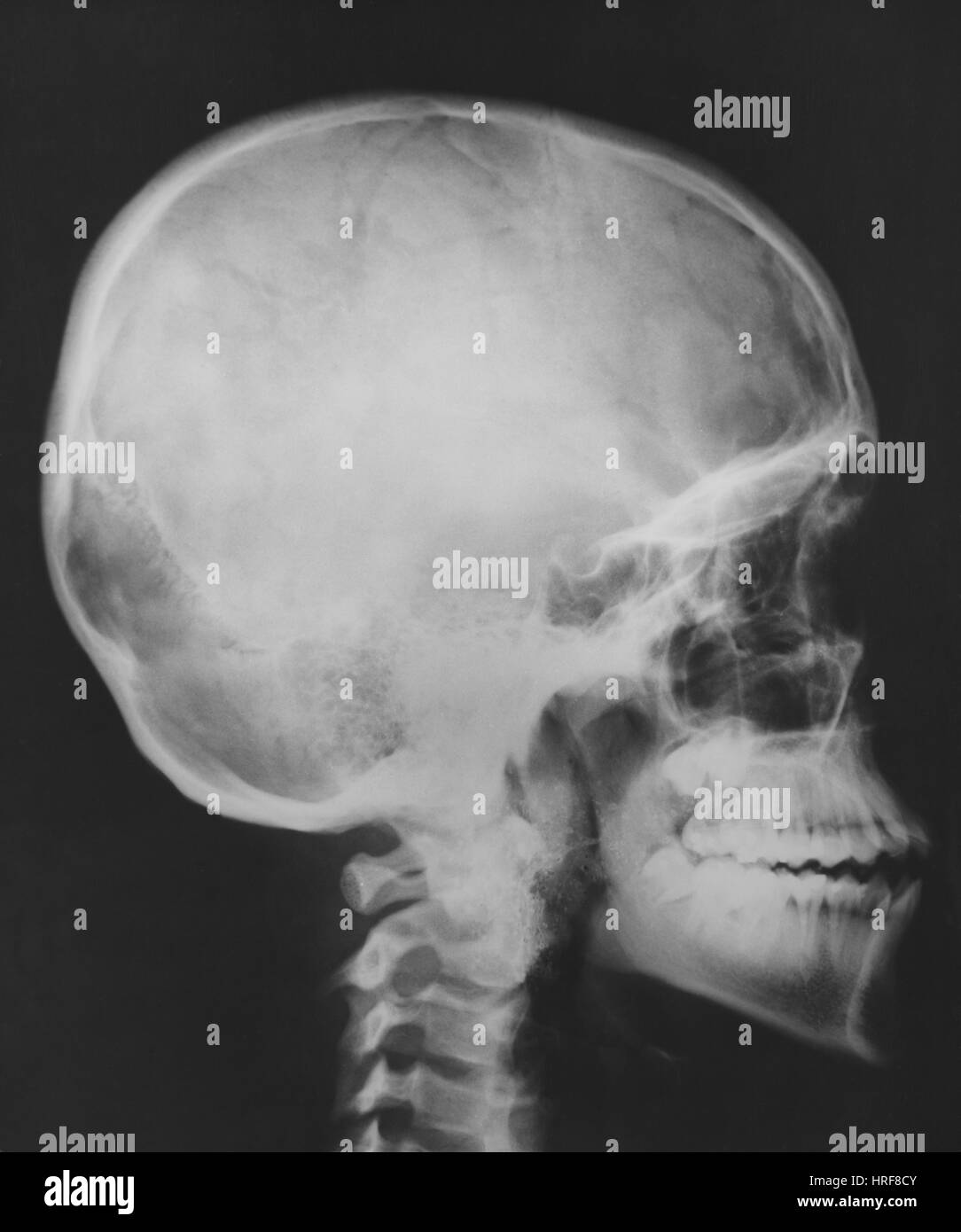 Normal skull x ray hi-res stock photography and images - Alamy