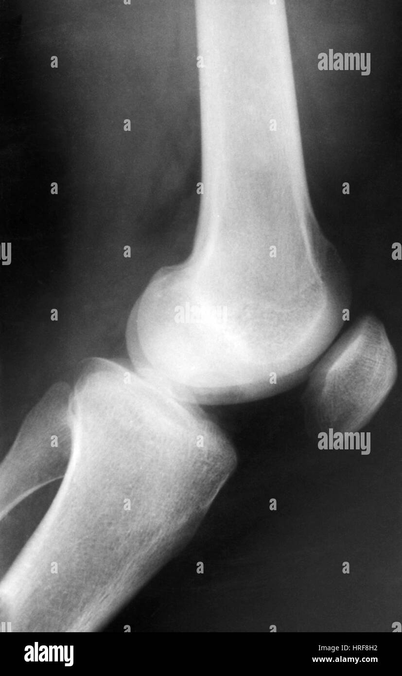 Normal knee x ray hi-res stock photography and images - Alamy