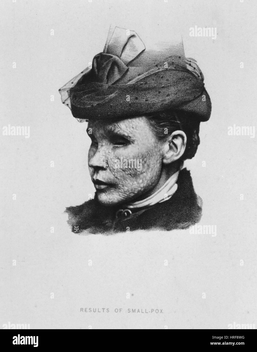 Small pox smallpox Black and White Stock Photos & Images - Alamy