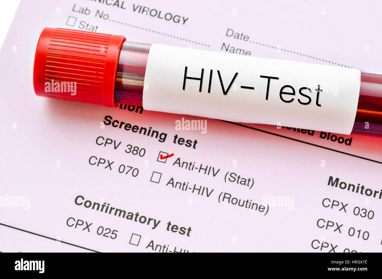 Sample blood collection tube with HIV test label on HIV infection ...