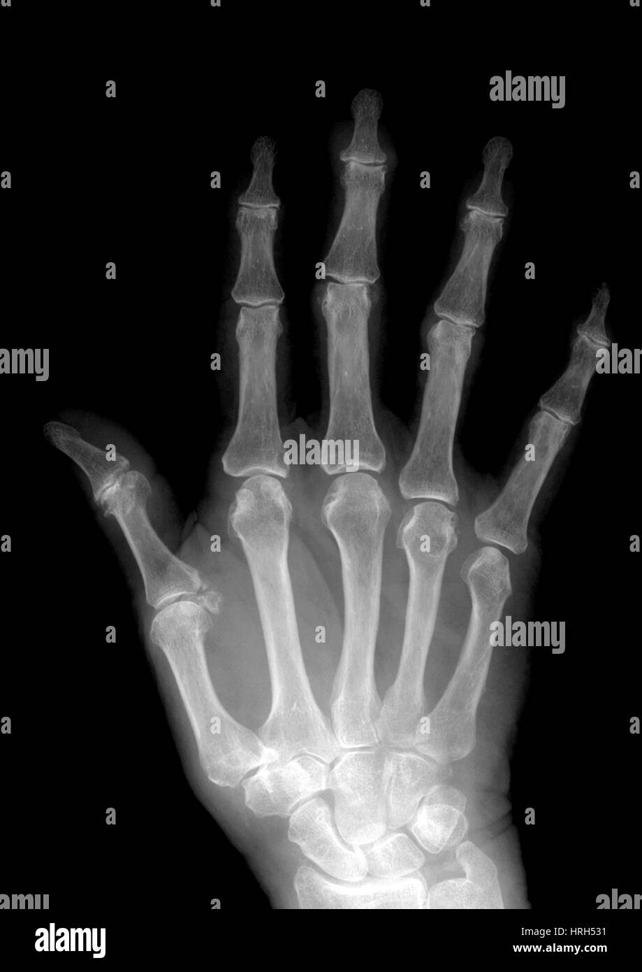 X ray abnormal finger hi-res stock photography and images - Alamy