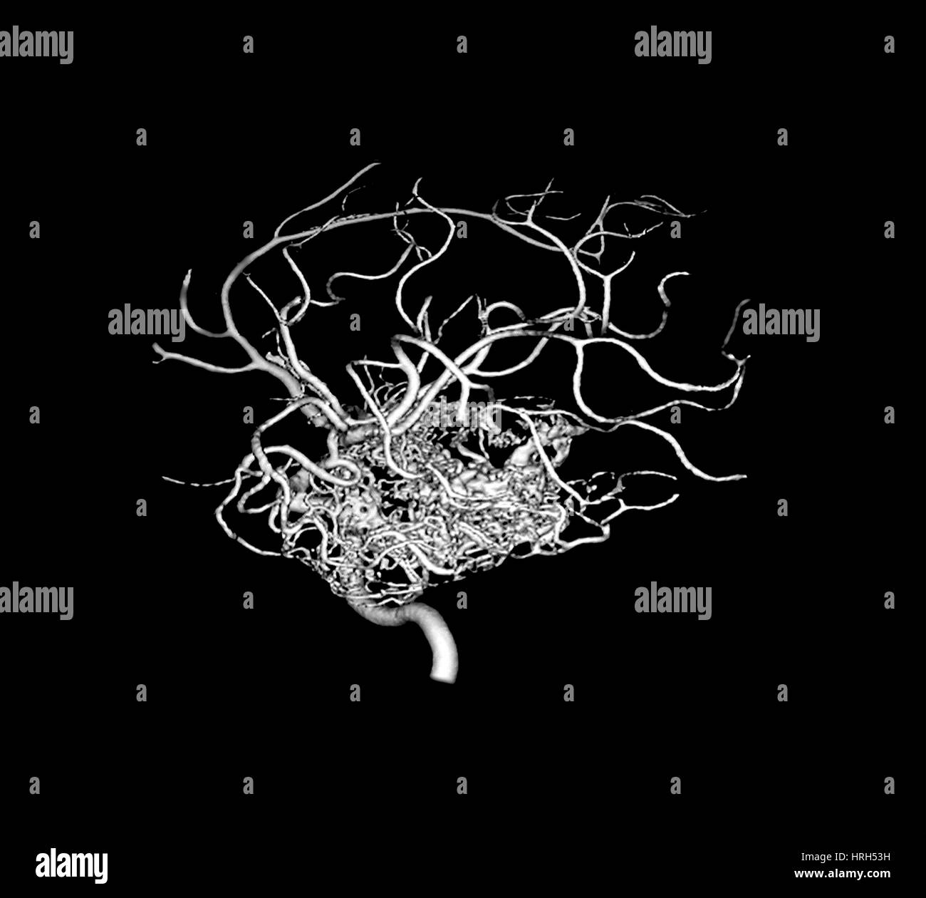 3d cerebral angiography hi-res stock photography and images - Alamy