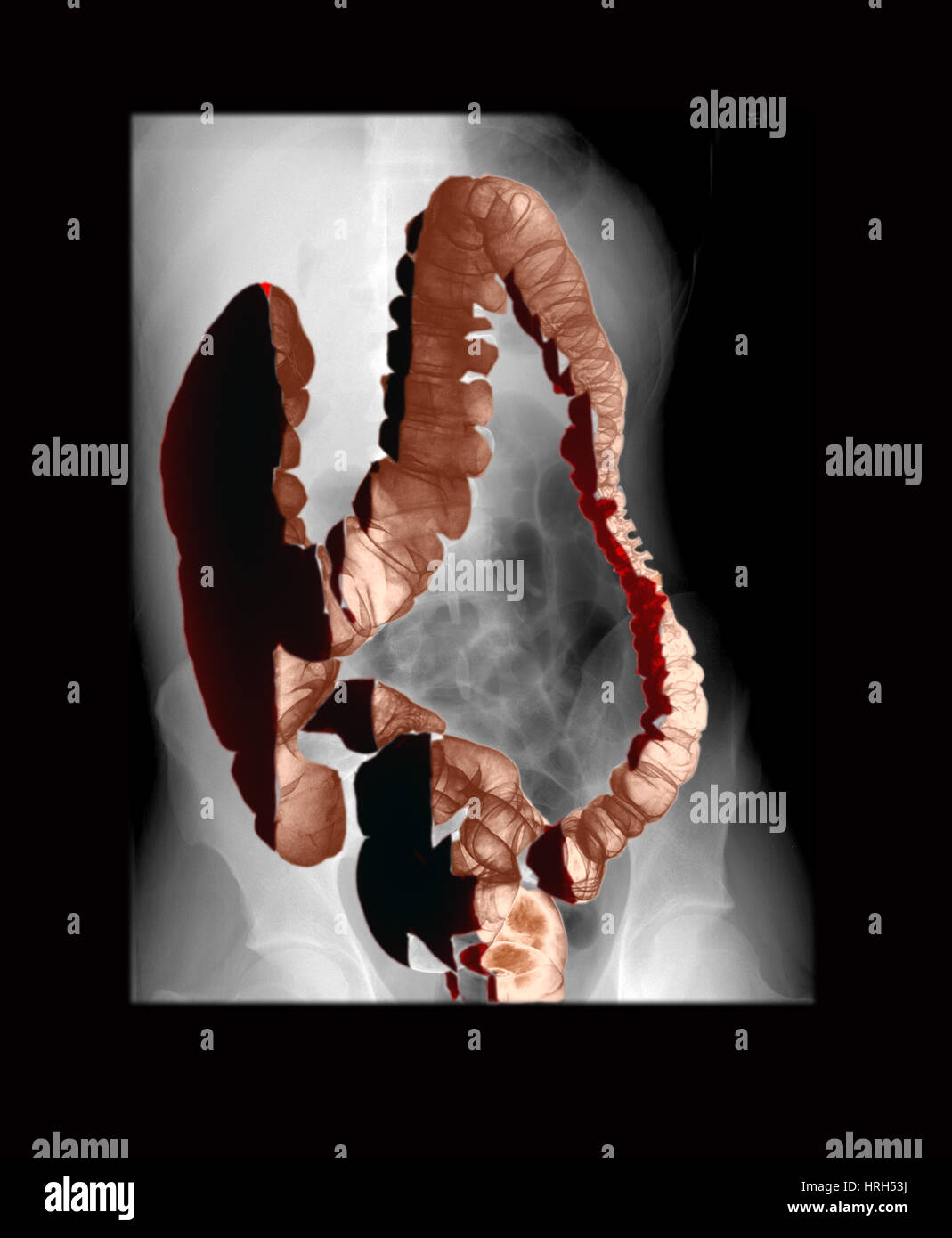 Barium enema x ray hi-res stock photography and images - Alamy