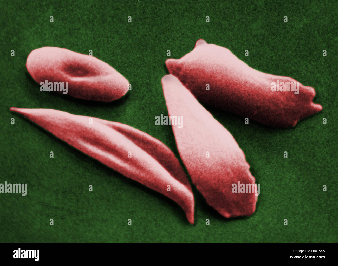 Sickle red blood cells Stock Photo - Alamy