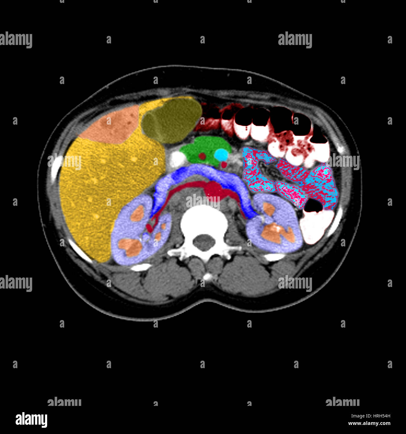 CT Cross Section of Liver Tumor Stock Photo - Alamy