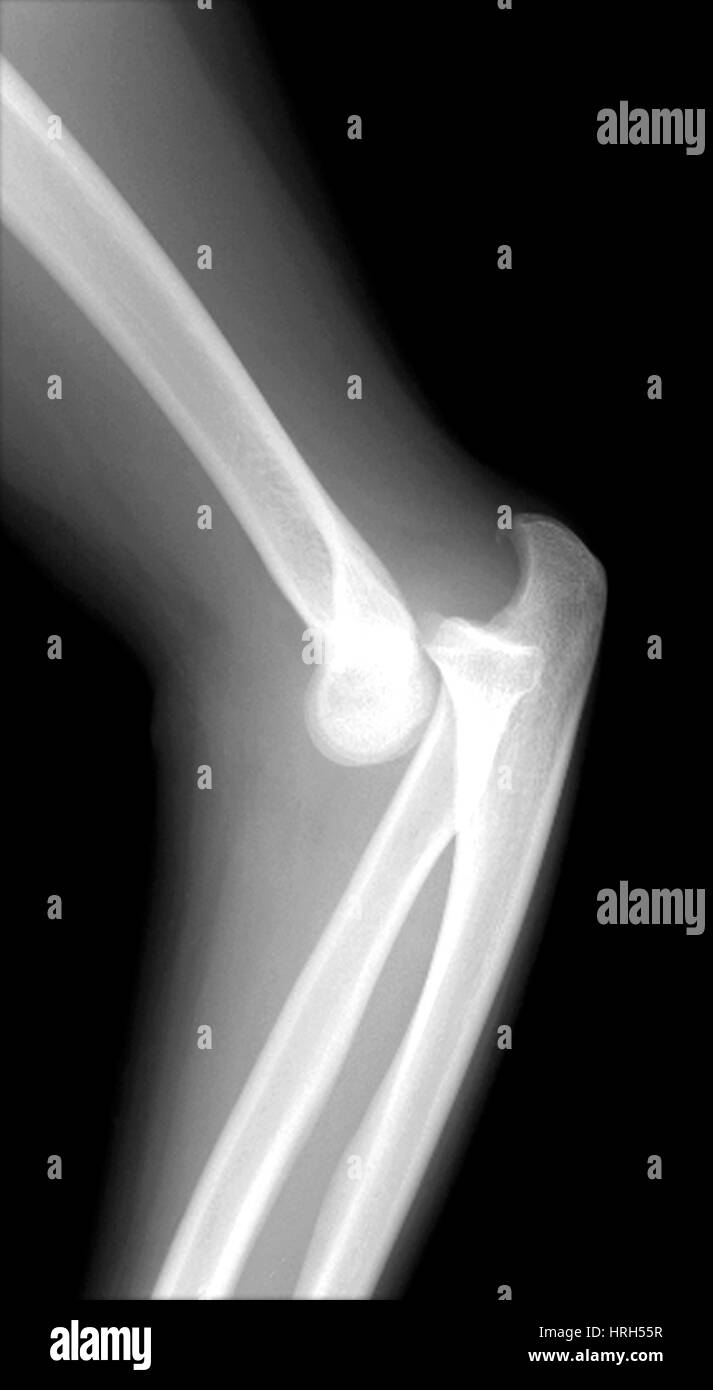 Elbow x ray hi-res stock photography and images - Alamy
