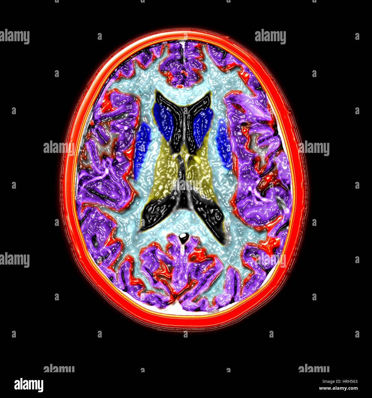 Normal brain, mri scans hi-res stock photography and images - Alamy Normal brain, mri scans hi-res stock photography and images - Alamy
