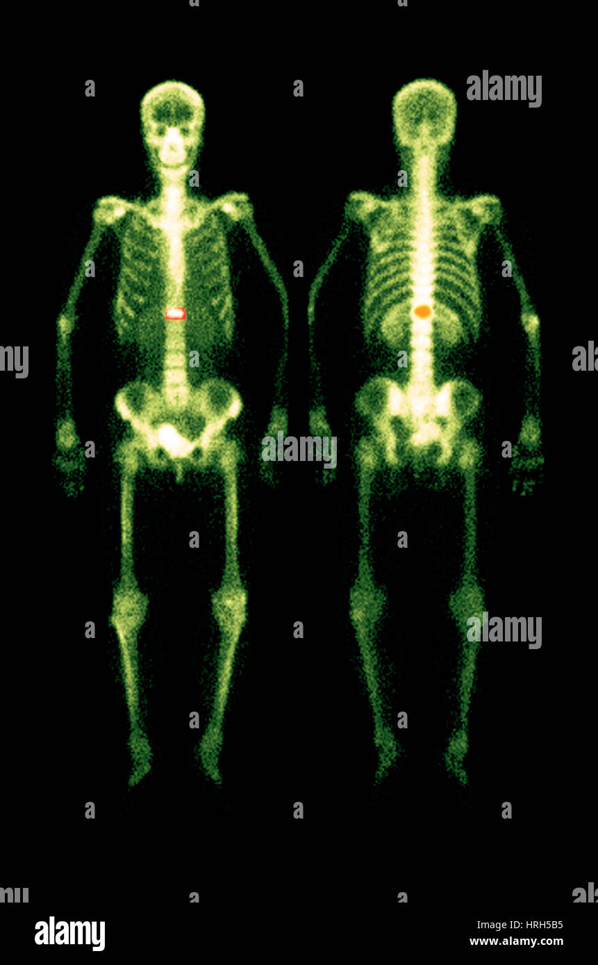 Abnormal bone scan hi-res stock photography and images - Alamy