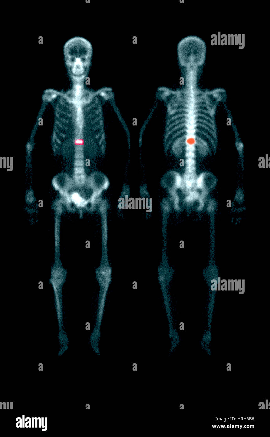 Abnormal bone scans hi-res stock photography and images - Alamy