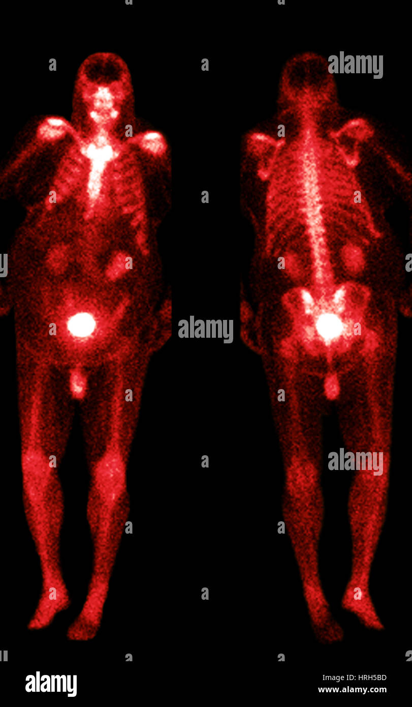 Abnormal bone scan hi-res stock photography and images - Alamy