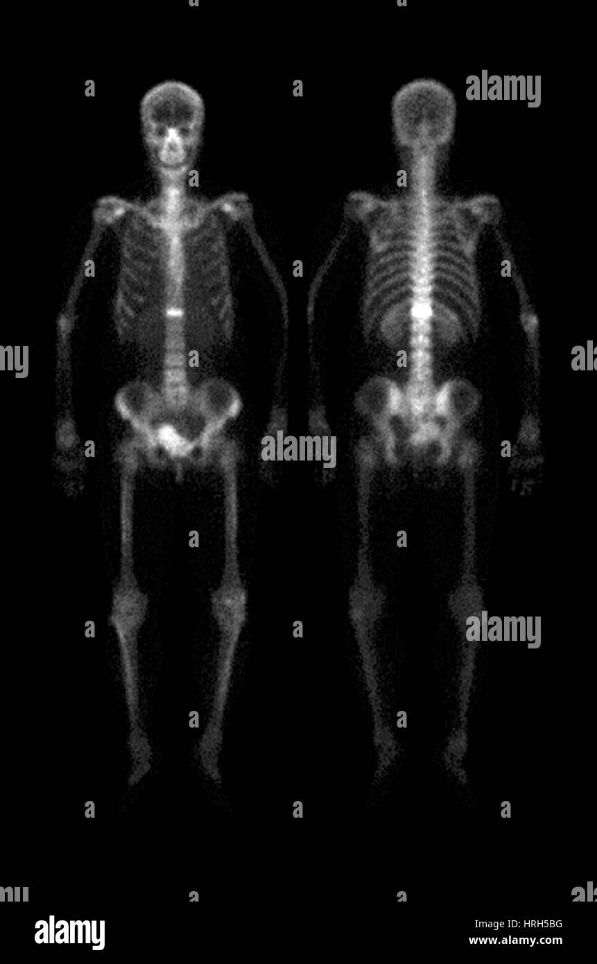 Fracture bone scan Black and White Stock Photos & Images - Alamy