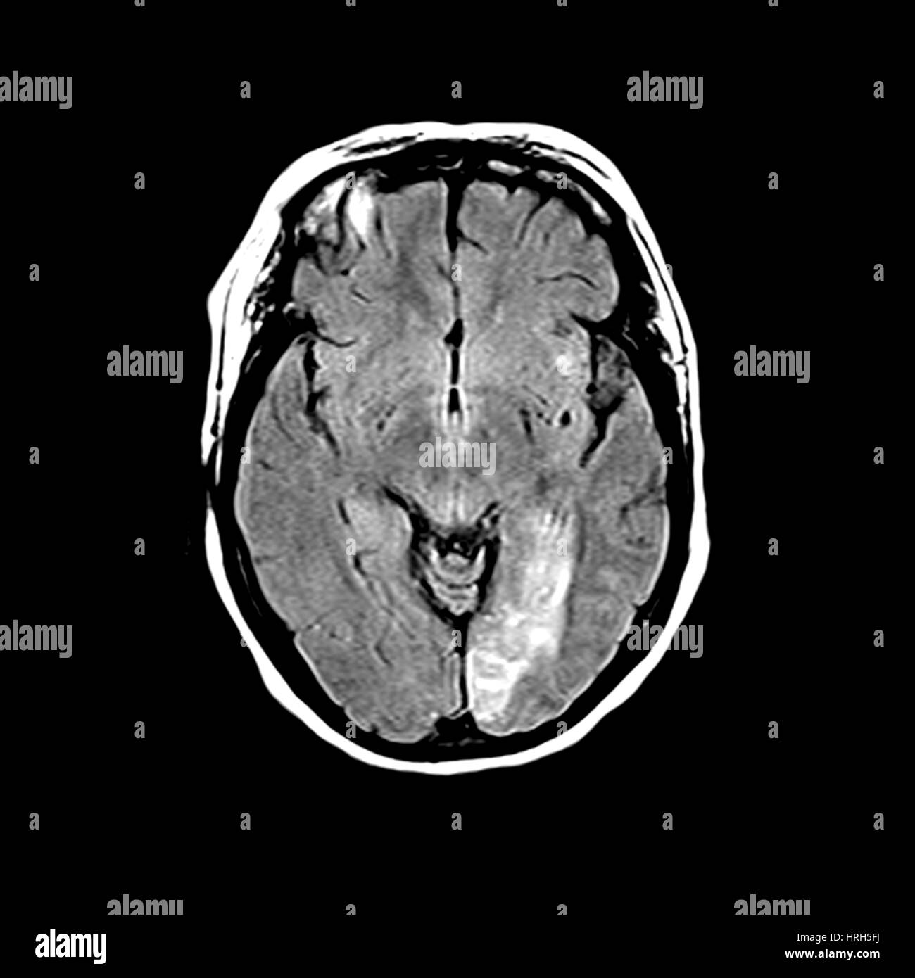 Abnormal mri brain Black and White Stock Photos & Images - Alamy