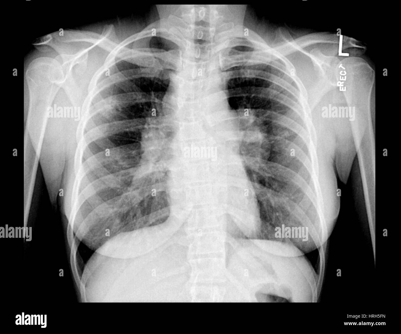 Mediastinal Lymphadenopathy