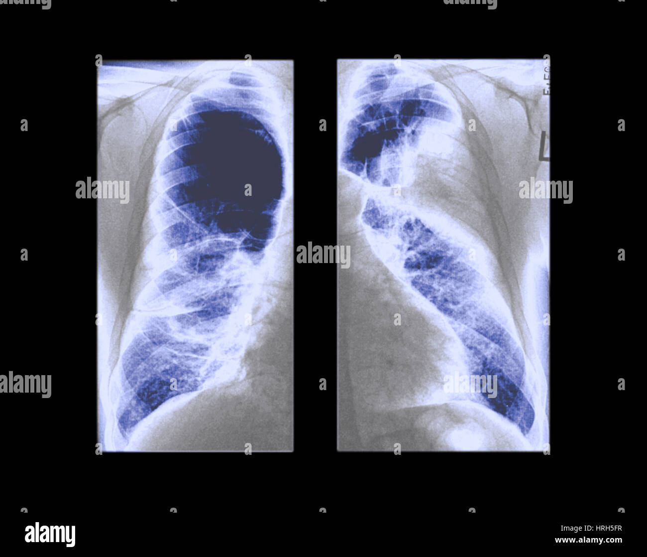 Emphysema x ray hi-res stock photography and images - Alamy