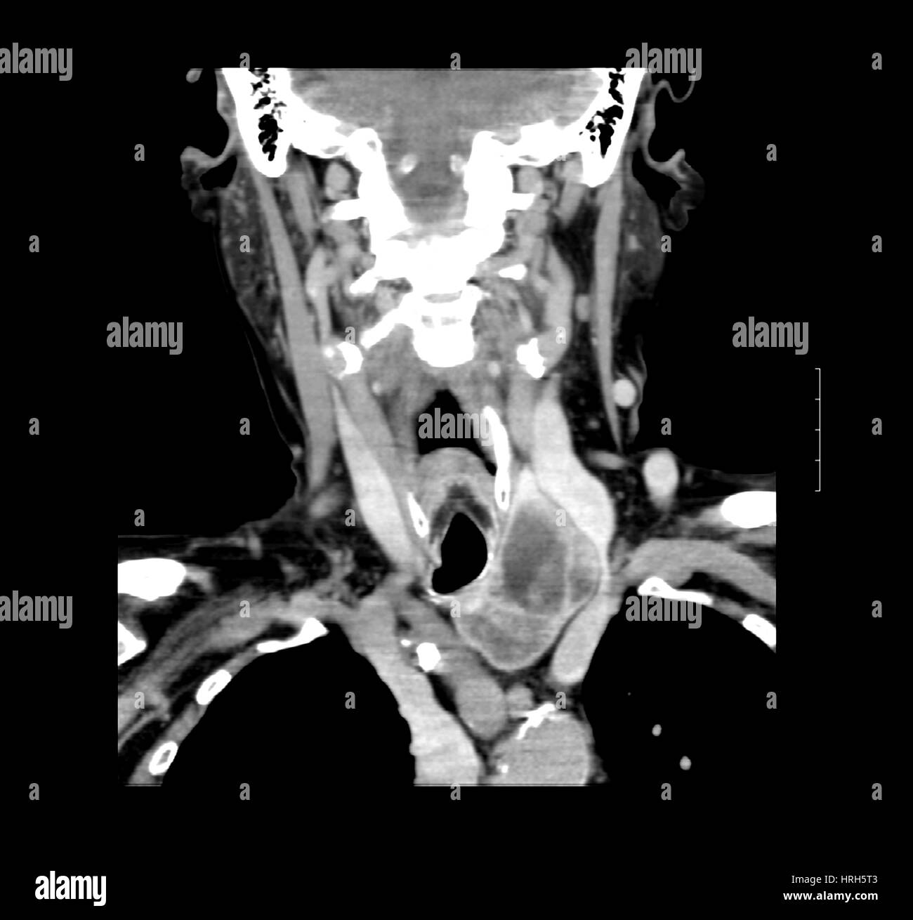 CT of Neck Showing Thyroid Goiter Stock Photo - Alamy