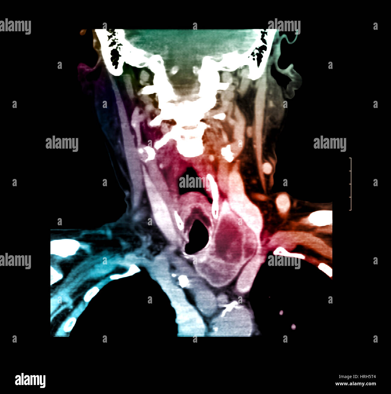 Thyroid goiter hi-res stock photography and images - Alamy