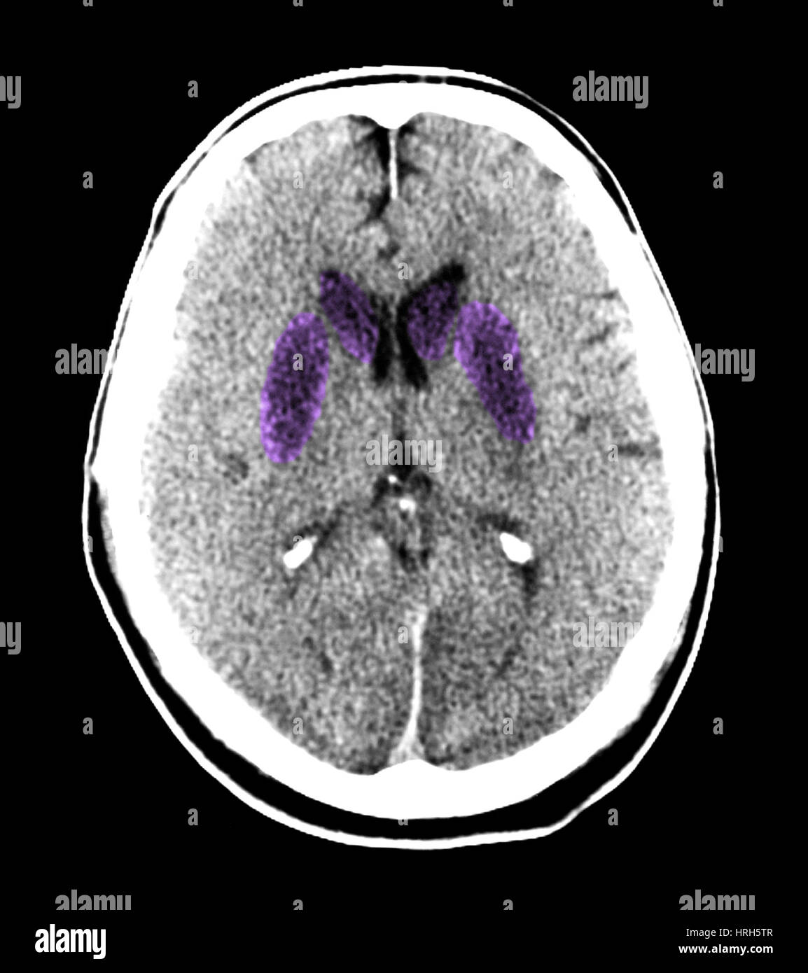 Abnormal ct of brain hi-res stock photography and images - Alamy