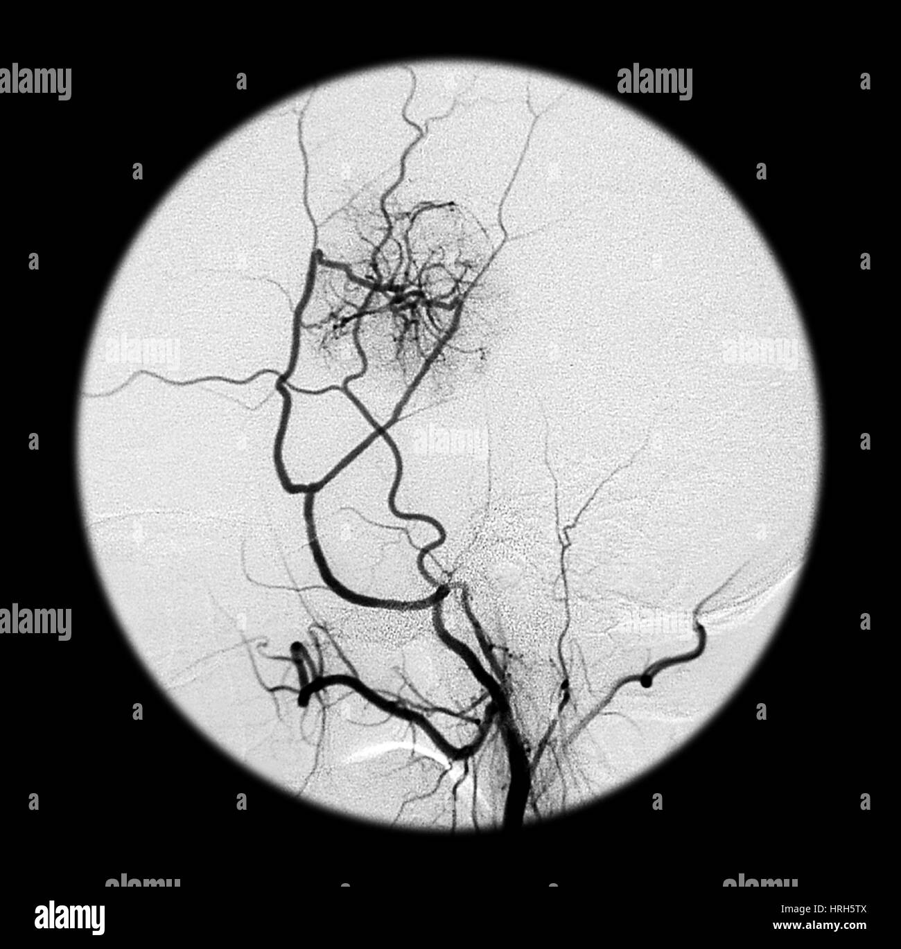 Abnormal Blood Flow Stock Photo - Alamy