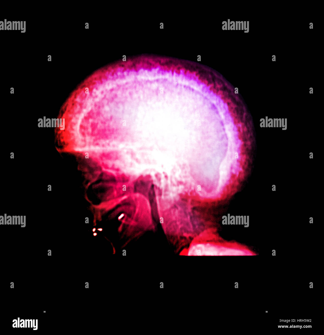 Pagets disease of bone hi-res stock photography and images - Alamy