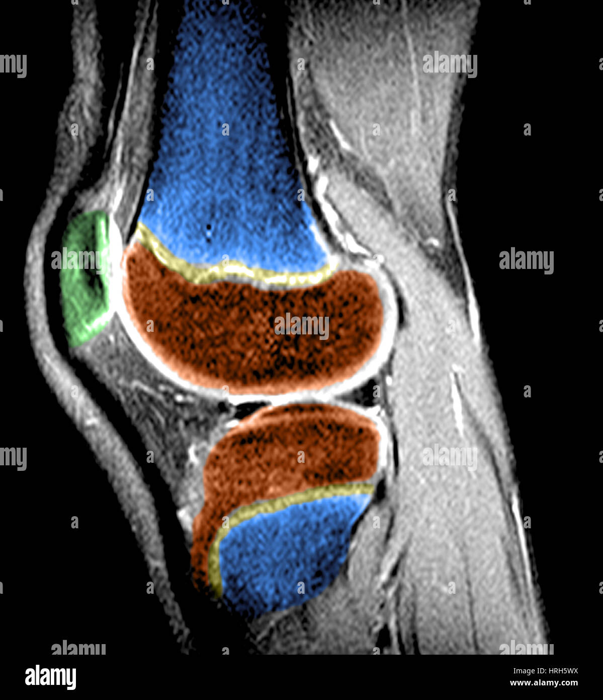 Mri Lower Knee