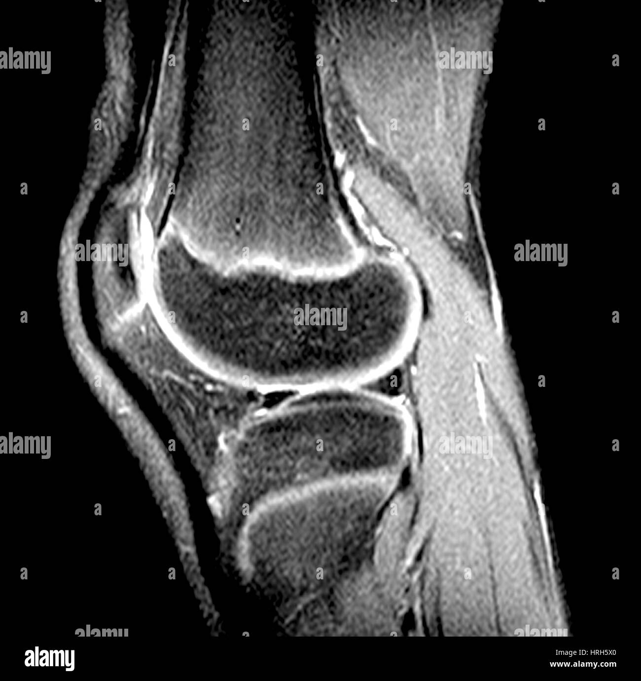 Normal Mri Knee