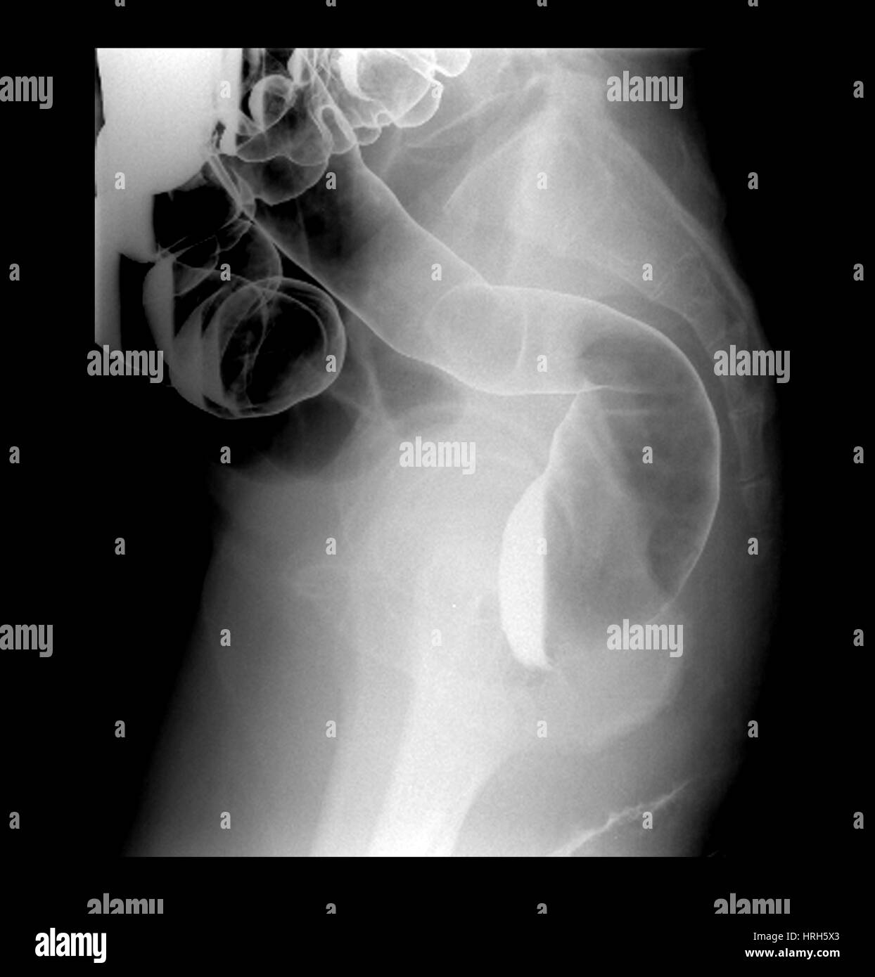 Enema Black and White Stock Photos & Images - Alamy