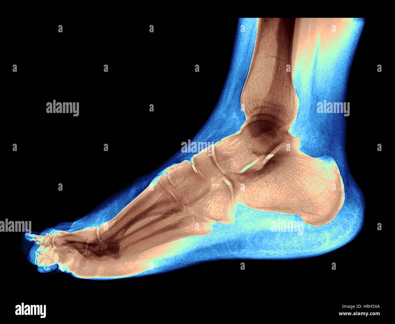 Radiograph Foot Stock Photos & Radiograph Foot Stock Images - Alamy