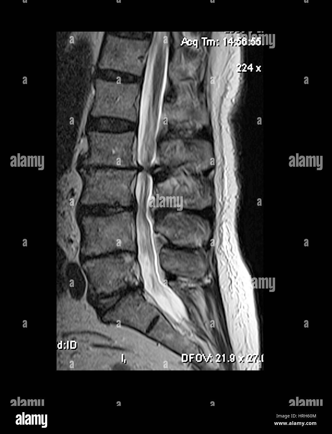 Spinal stenosis xray hi-res stock photography and images - Alamy