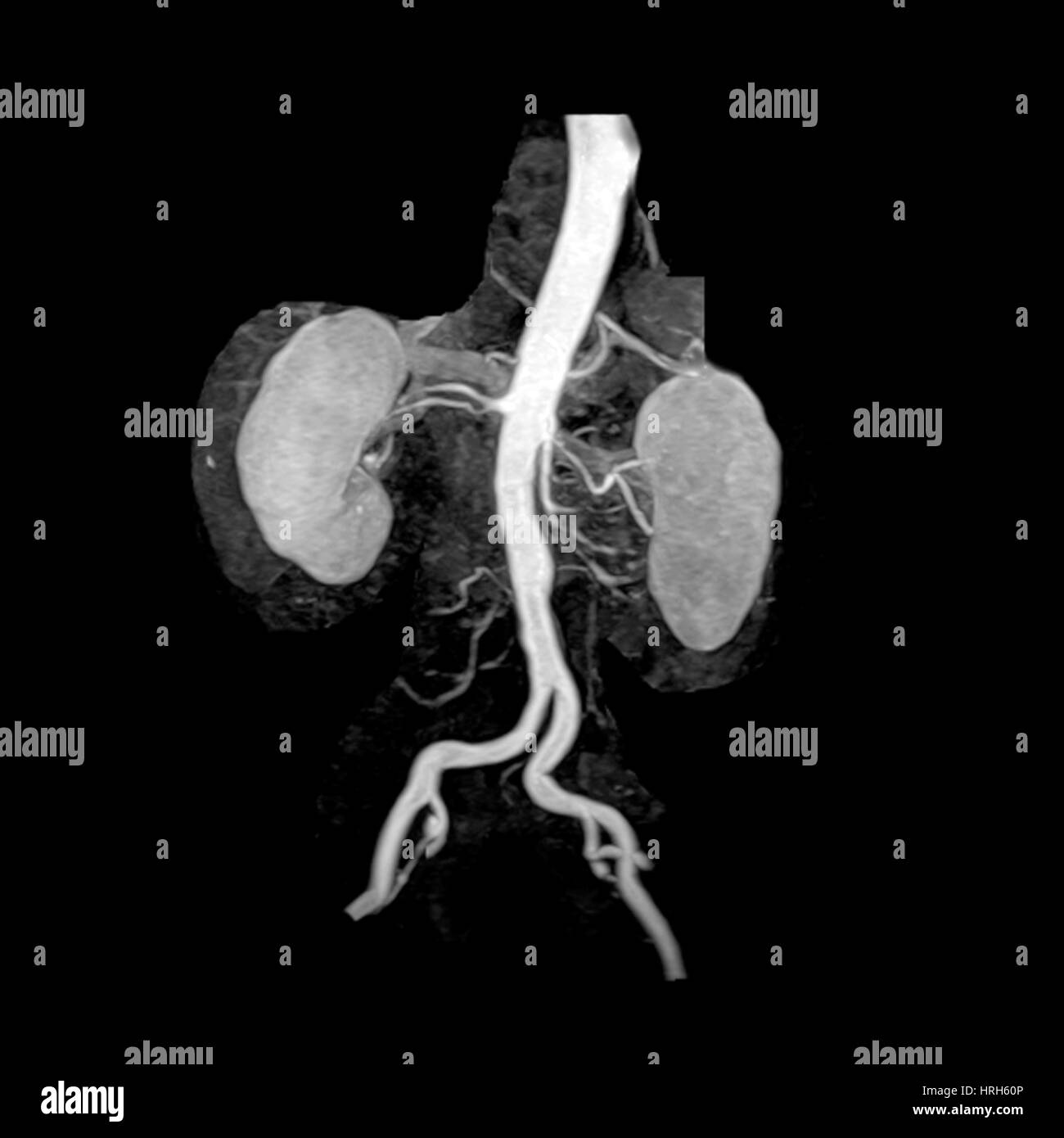 Angiogram of abdominal aorta Black and White Stock Photos & Images - Alamy