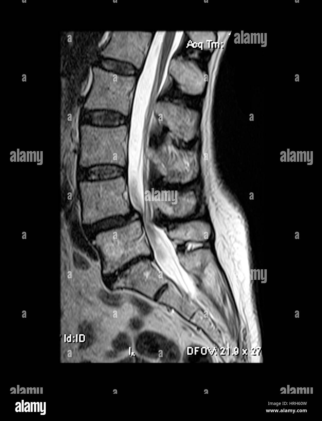 Spondylolisthesis Mri