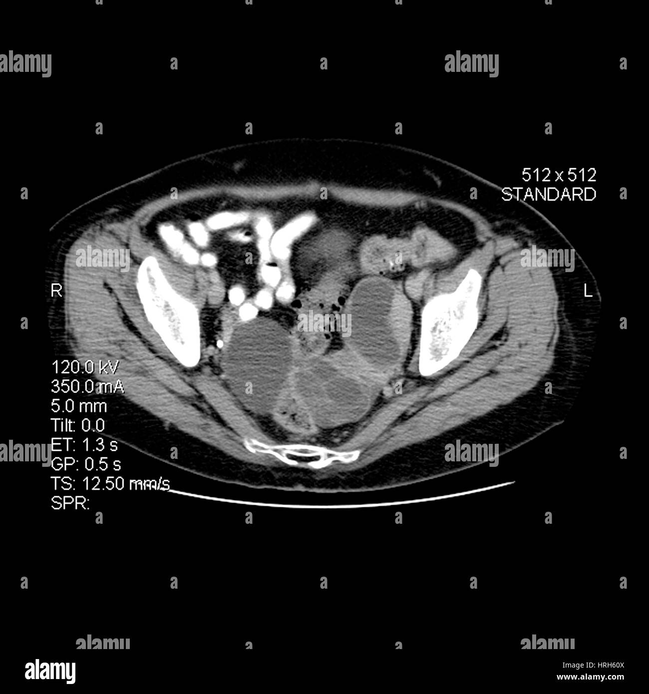 Xray of an ovarian tumor hi-res stock photography and images - Alamy