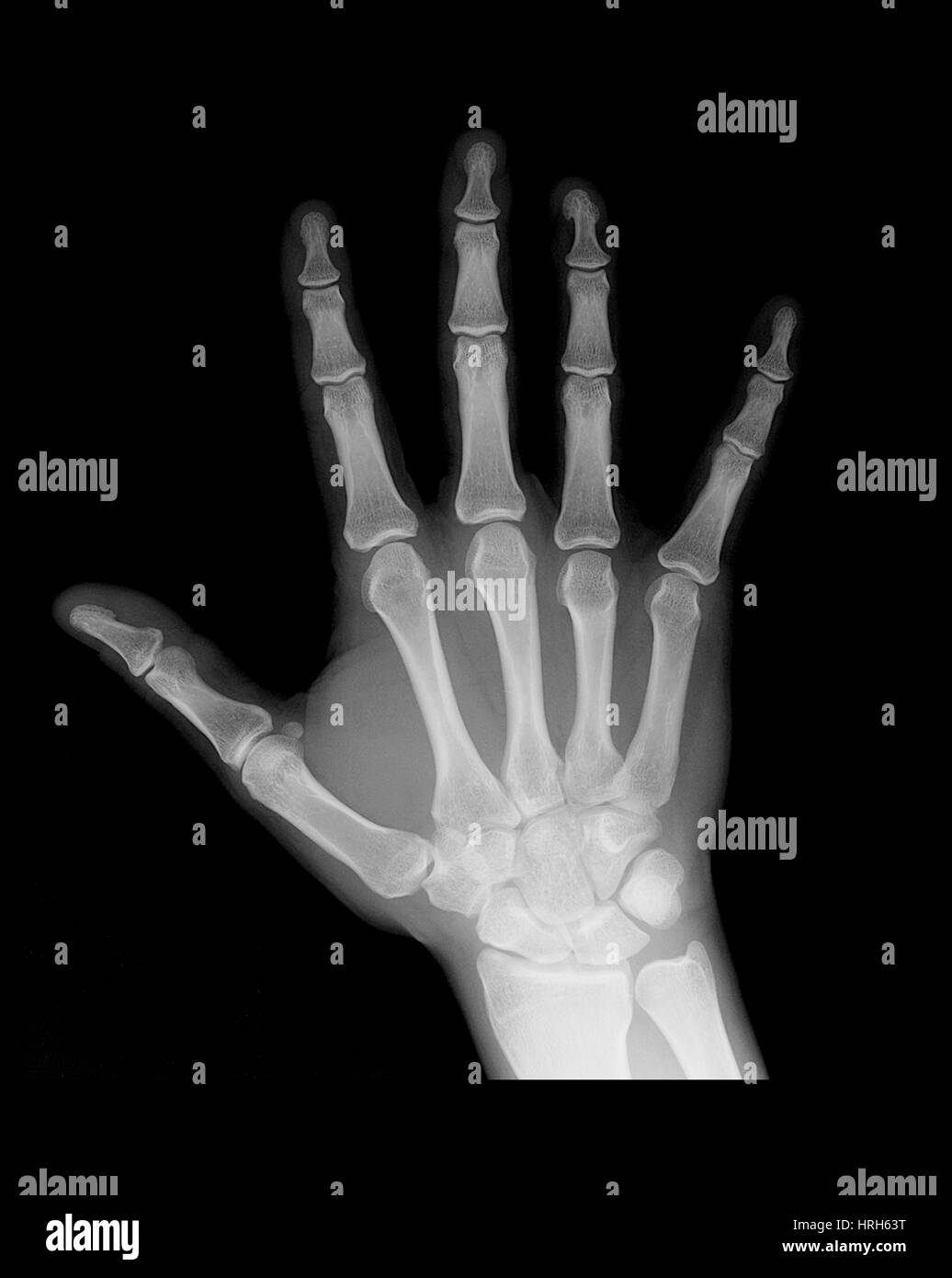 Xray hand normal hi-res stock photography and images - Alamy