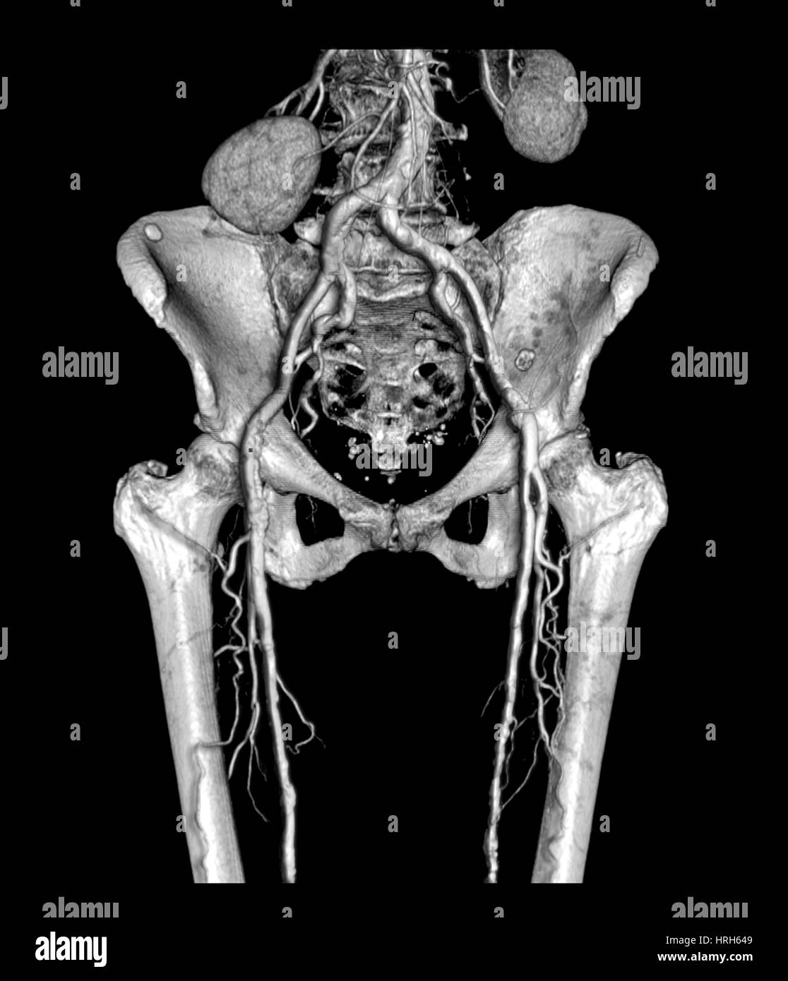 Cta of pelvis hi-res stock photography and images - Alamy