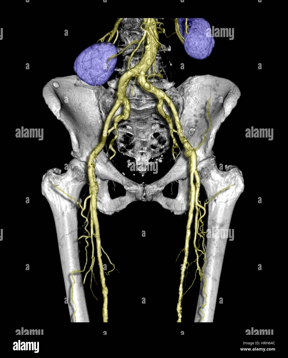 Cta of pelvis hi-res stock photography and images - Alamy