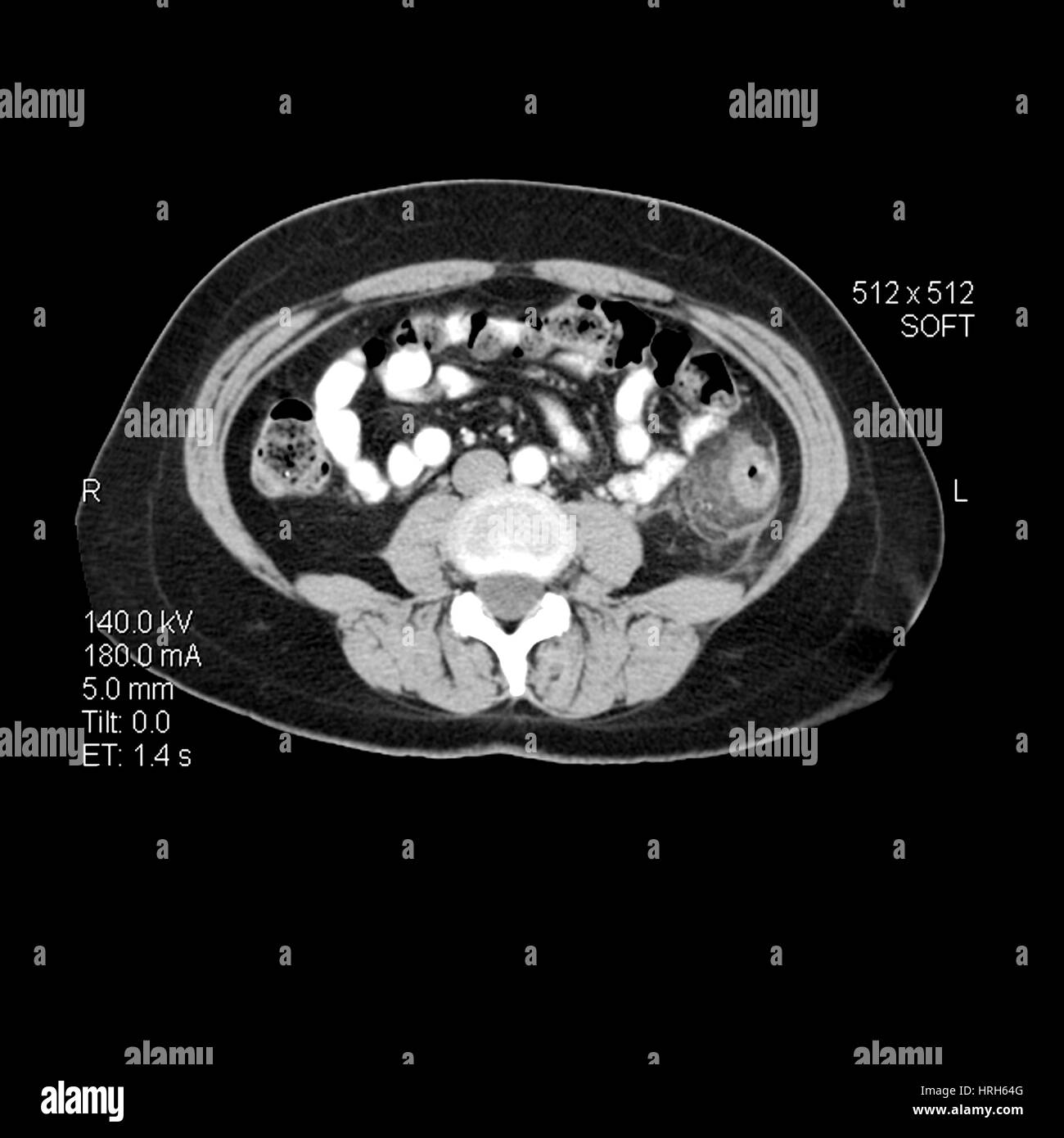 CT image of Diverticulitis Stock Photo - Alamy
